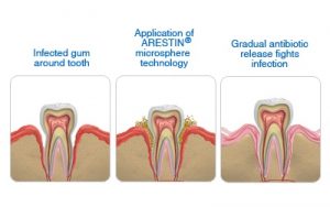 Periodontics Houston, TX | Dr. Coker & Dr. Ho | Arestin